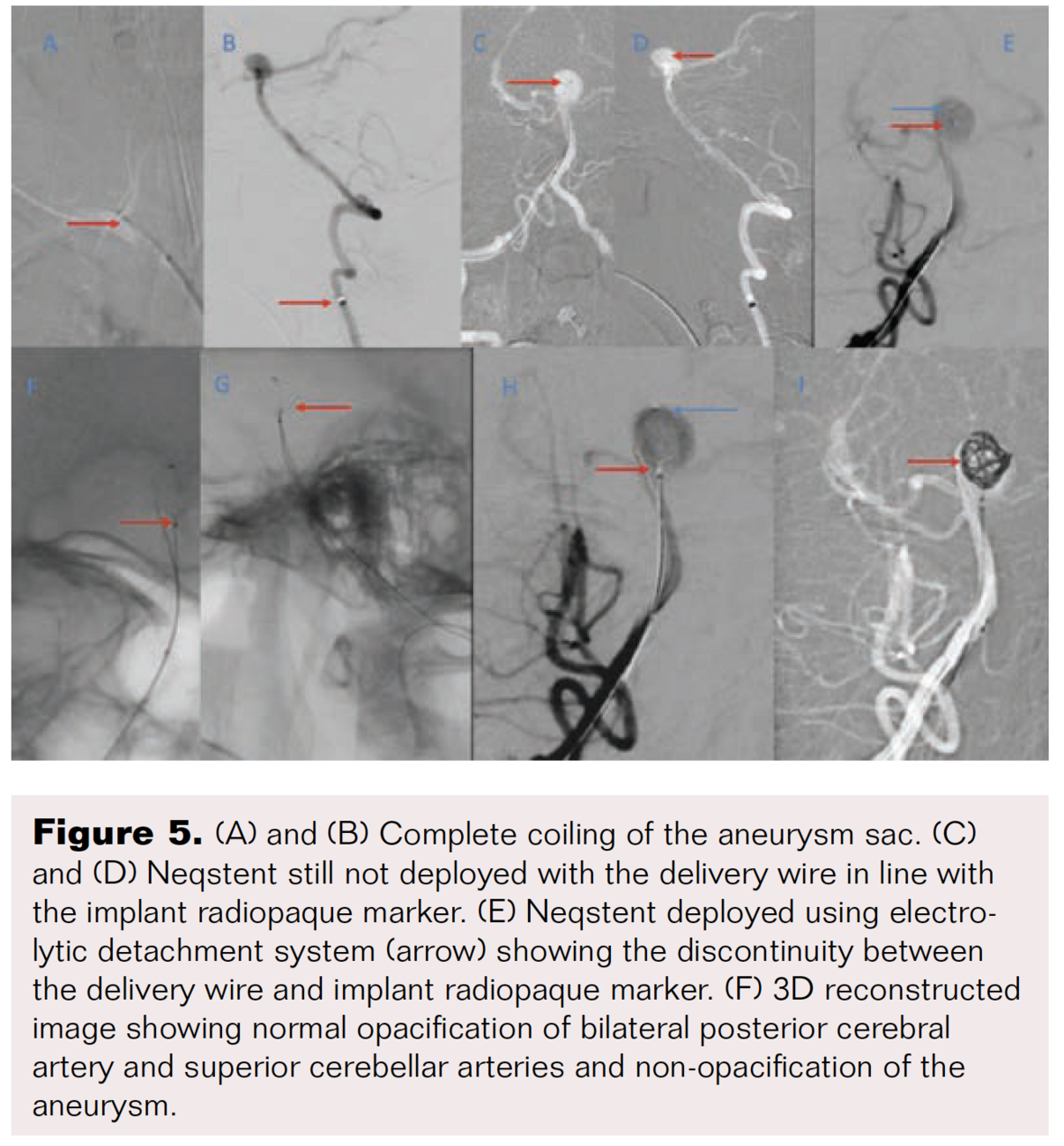 Coil-Assisted Flow Diversion in a Ruptured Aneurysm | VDM